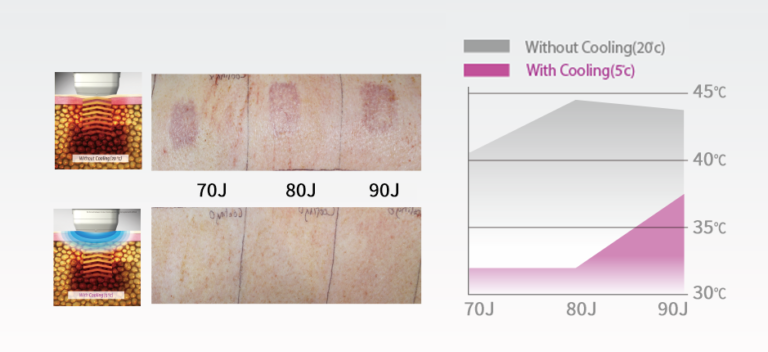 Lipocel II – Jeisys Global